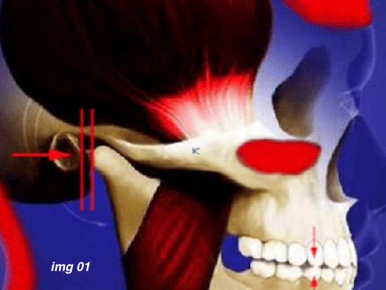 TMJ Disorders: How Your Teeth Could Be Causing You Headaches - Dental ...